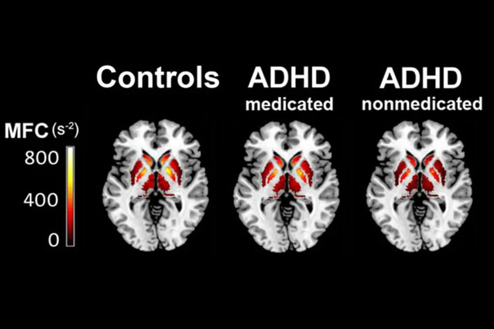 Medical updates: What is ADHD? 3 types of ADHD , Symptoms and treatment ...